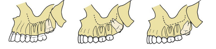 Cirurgia para remoção de dentes inclusos/impactados: de fato, é preciso ...